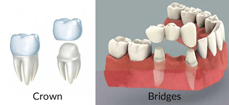 Crown And Bridges | Vrushabha Dental